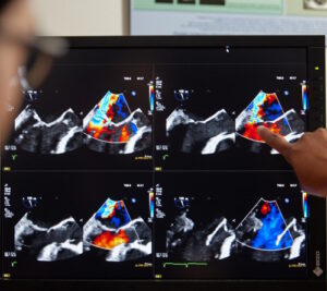 Echocardiogram - Northern Hearts Cardiology